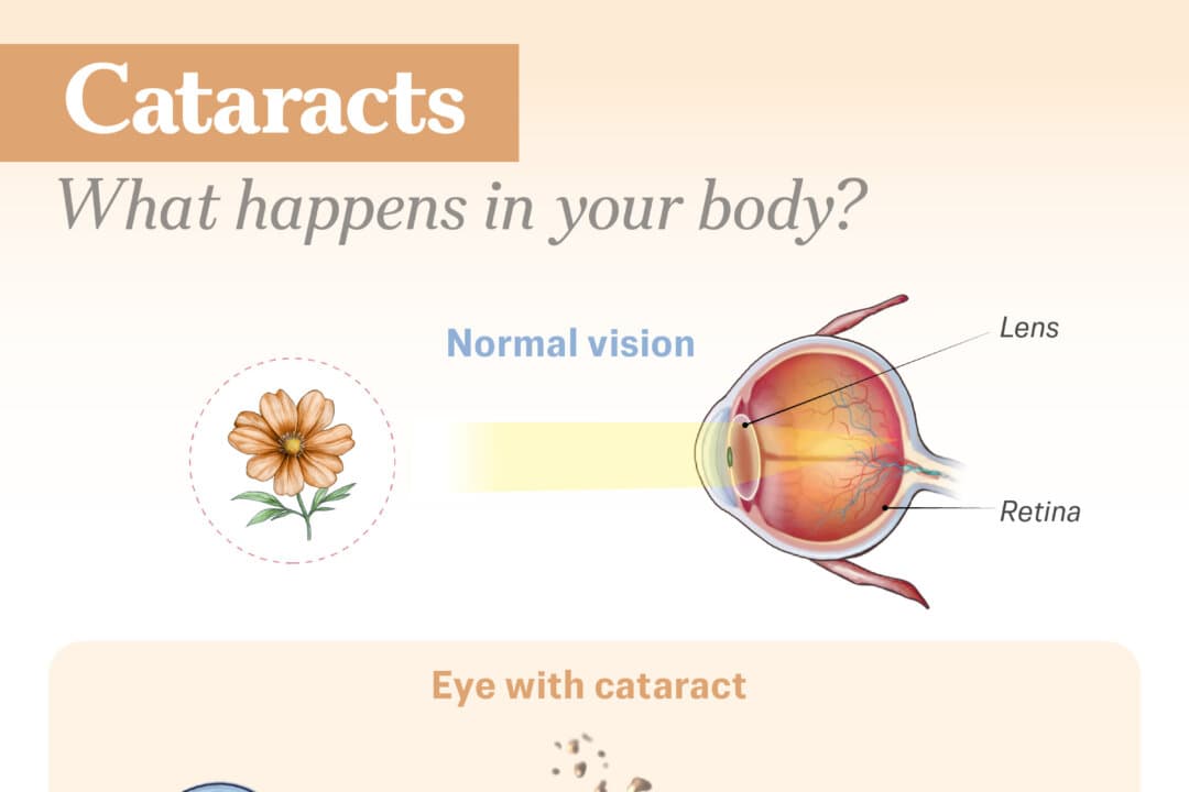 Cataracts: Leading Cause of Blindness–Here Are Its Early Signs ...